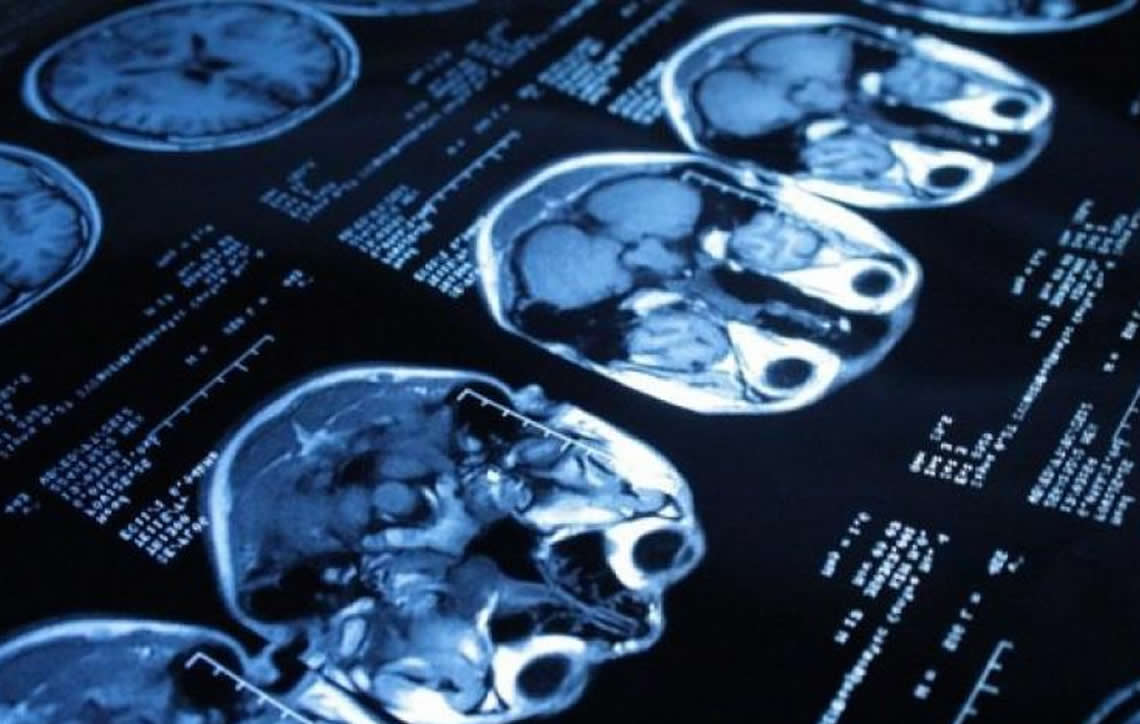 ContextoExato - Desequilíbrio do pH no cérebro pode ser causa de Alzheimer